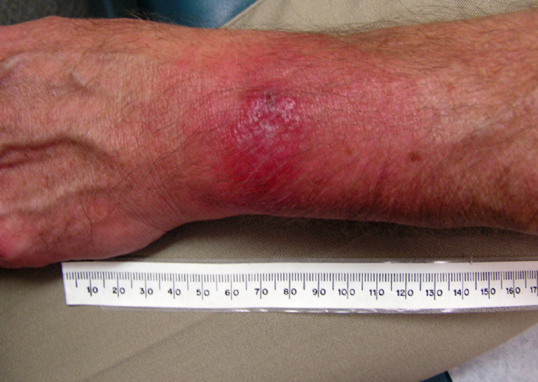 Uniformly Red Lesions