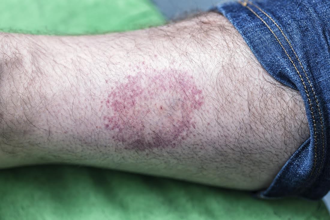 Multiple Rashes From Disseminated Infection